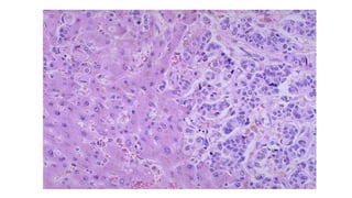 Surgical pathology of hepatobiliary tree and pancreas | PPTX