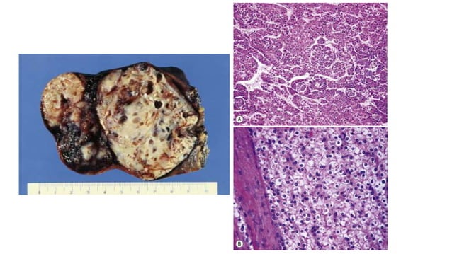 Surgical pathology of hepatobiliary tree and pancreas | PPT
