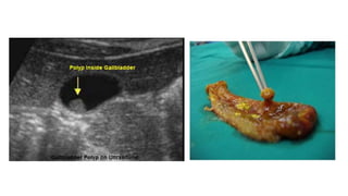 Surgical pathology of hepatobiliary tree and pancreas | PPTX