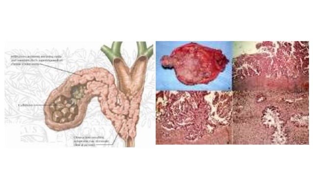 Surgical pathology of hepatobiliary tree and pancreas | PPT
