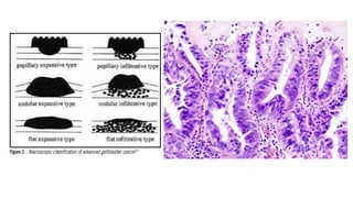 Surgical pathology of hepatobiliary tree and pancreas | PPTX