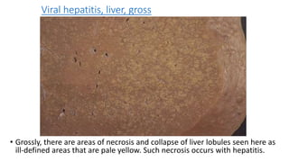 Surgical pathology of hepatobiliary tree and pancreas | PPTX
