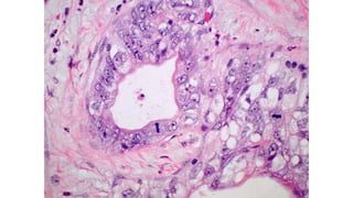 Surgical pathology of hepatobiliary tree and pancreas | PPTX