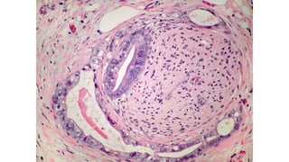 Surgical pathology of hepatobiliary tree and pancreas | PPTX