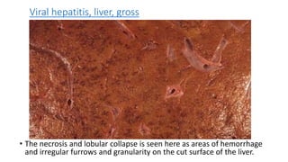 Surgical pathology of hepatobiliary tree and pancreas | PPTX
