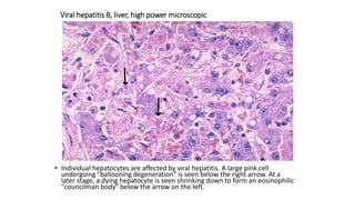 Surgical pathology of hepatobiliary tree and pancreas | PPTX