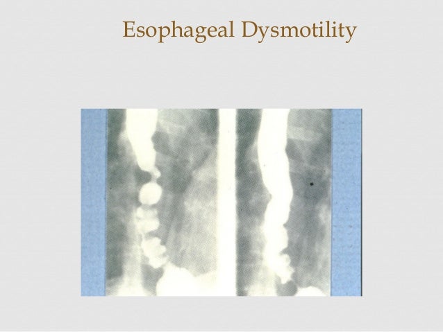 Esophageal Dysmotility