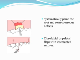 Surgical peridontal therapy | PPTX