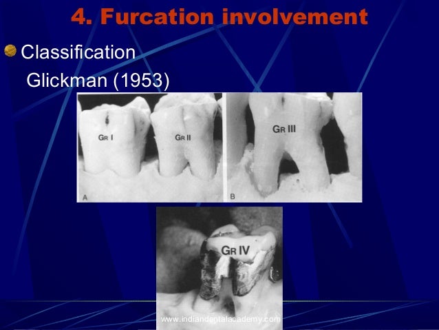 Surgical procedures in fixed partial dentures / dentistry dental impl…