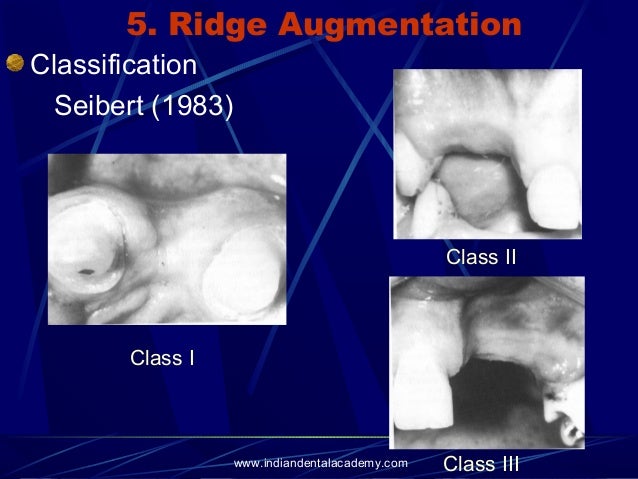 Surgical procedures in fixed partial dentures / dentistry dental impl…
