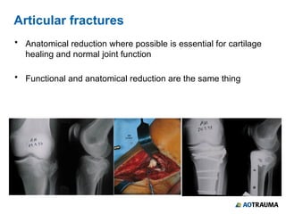 Surgical Reduction Techniques - AOTME.pptx
