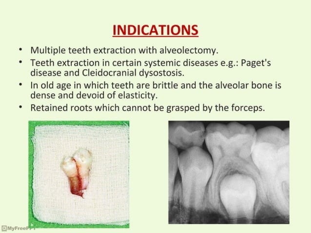 SURGICAL REMOVAL OF TEETH AND ROOTS.pptx