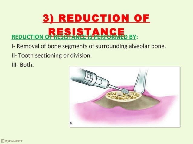 SURGICAL REMOVAL OF TEETH AND ROOTS.pptx