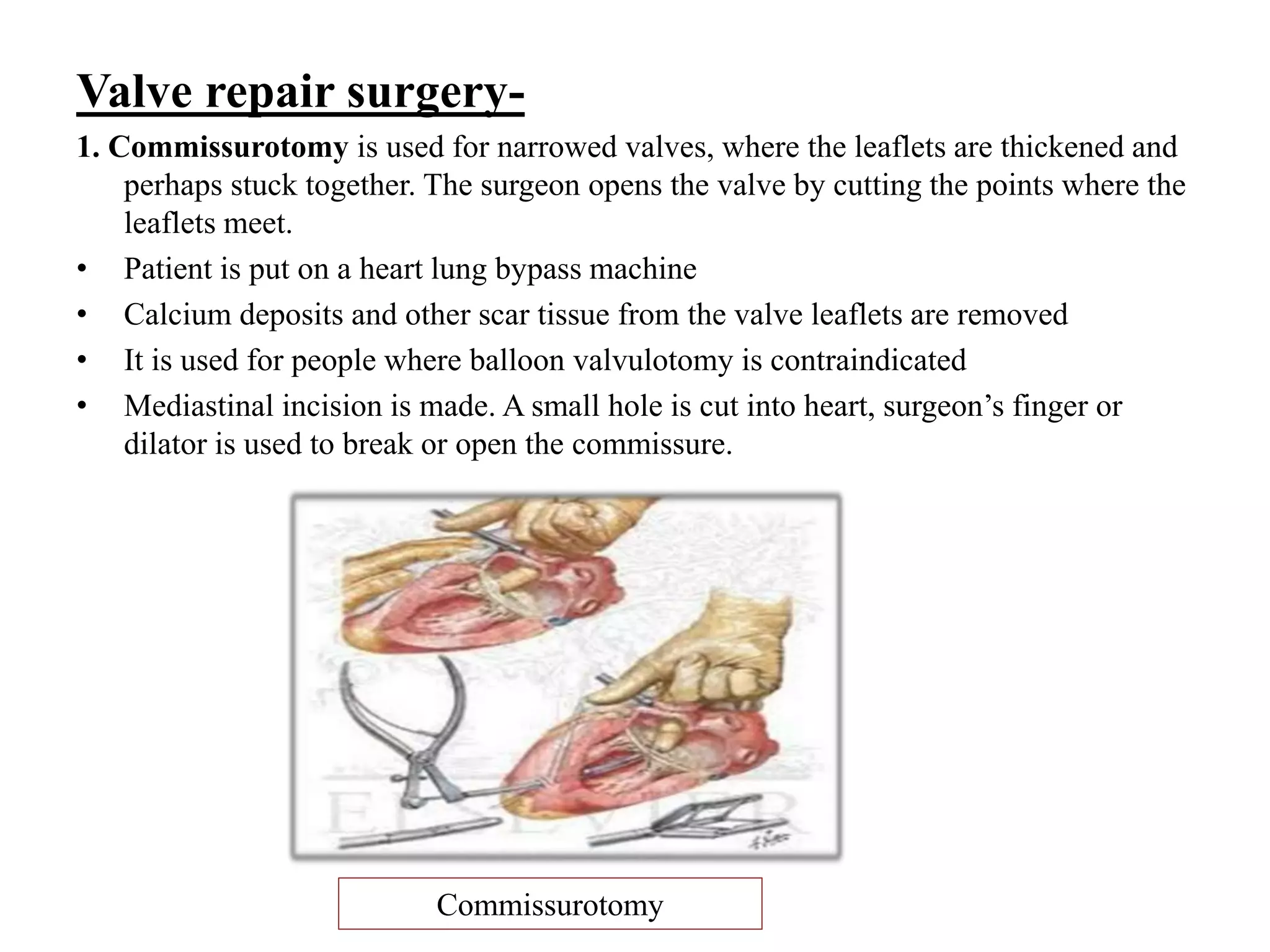 Surgical repair and replacement of diseased valves ppt. | PPTX