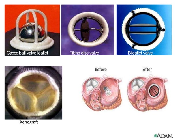 Surgical repair and replacement of diseased valves ppt. | PPTX | Heart ...