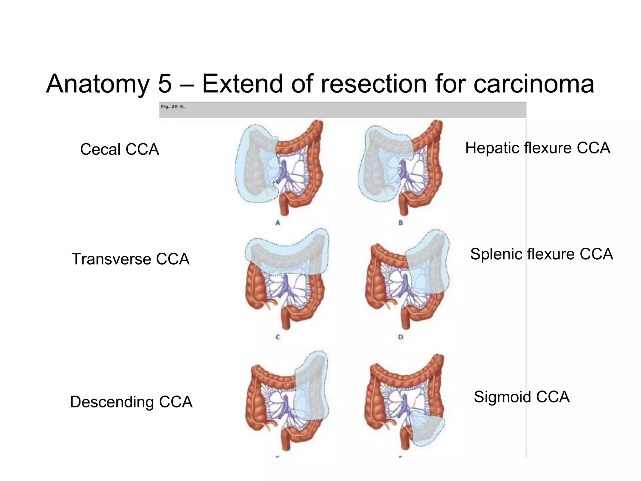Surgical resections and staging of colorectal carcinoma | PPTX
