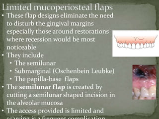 Surgical re treatment ( an overview) | PPT