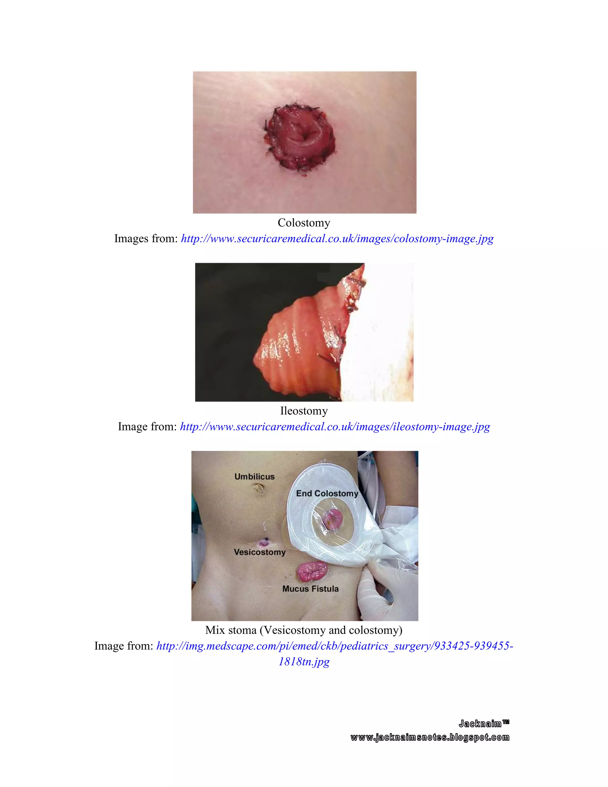 Surgical short case stoma | PDF | Digestive Disorders | Diseases and ...