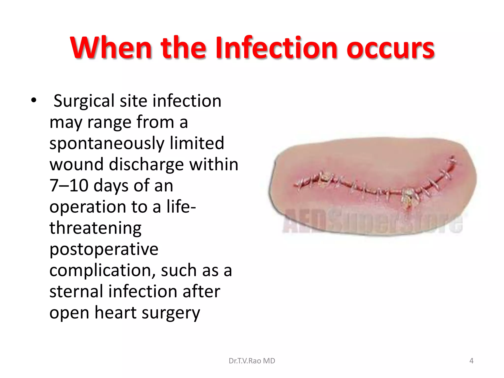 SURGICAL SITE INFECTIONS PREVENTION AND CARE | PPTX