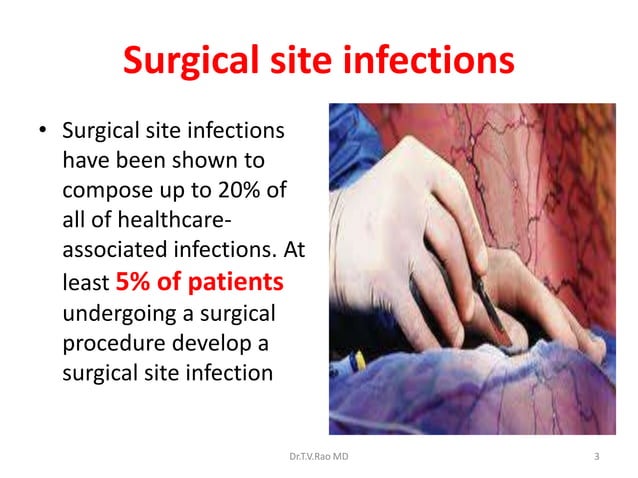 Wound Irrigation For Preventing Surgical Site Infections – XNCUC