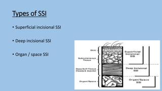 Surgical site infection | PPTX | Infectious Diseases | Diseases and ...