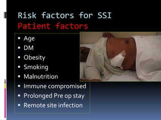 Surgical site infection | PPTX