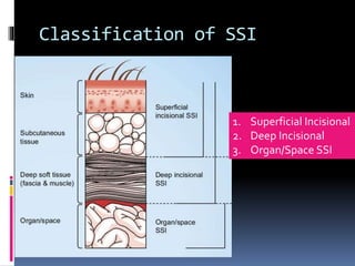 Surgical site infection | PPTX