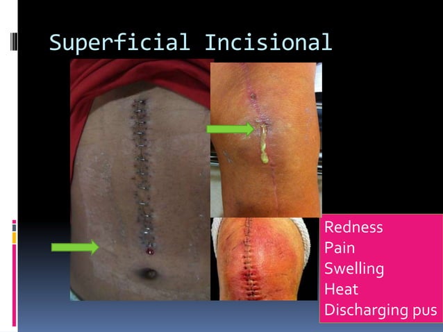 Surgical site infection