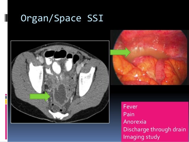 Surgical site infection