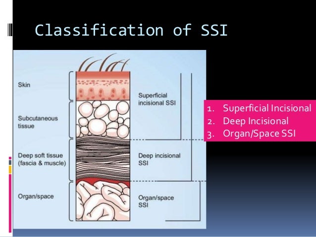 Surgical site infection