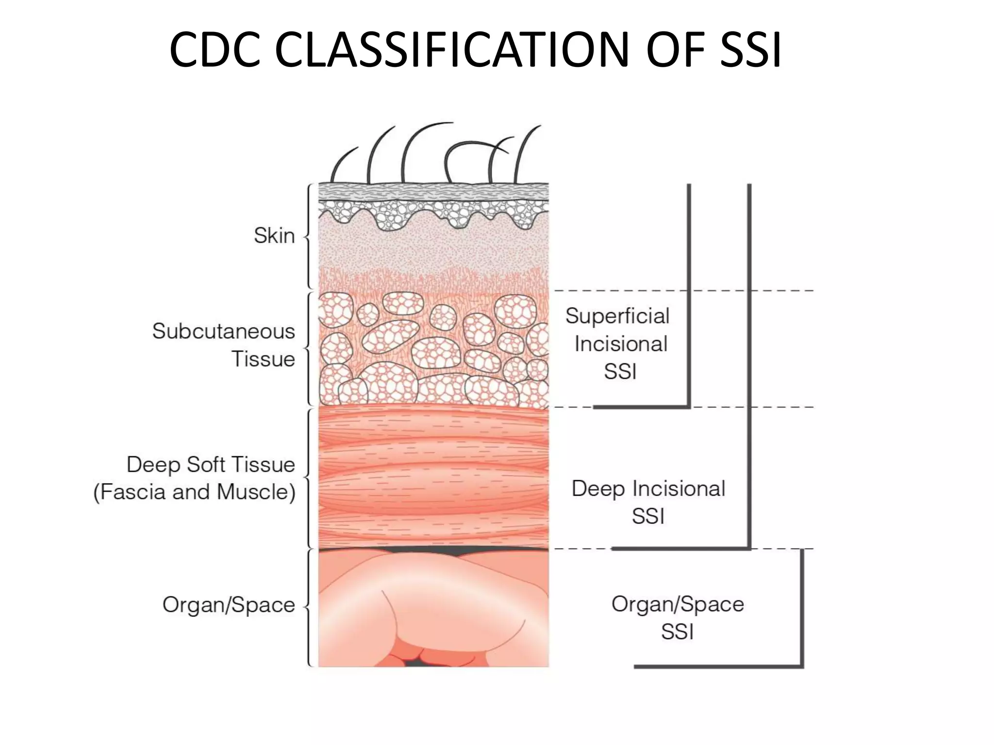 Surgical Site Infection | PPT