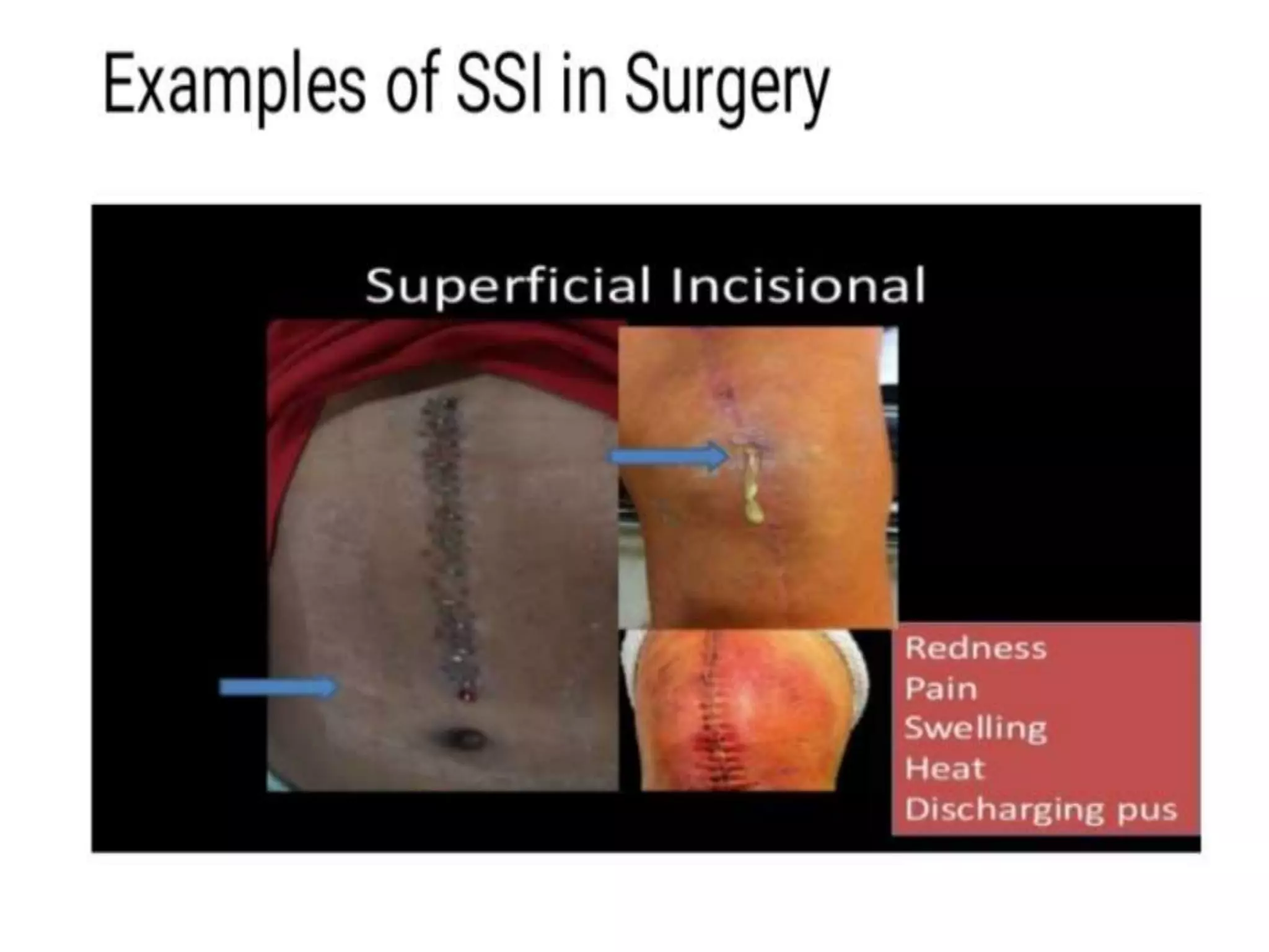 SURGICAL SITE INFECTION.pptx