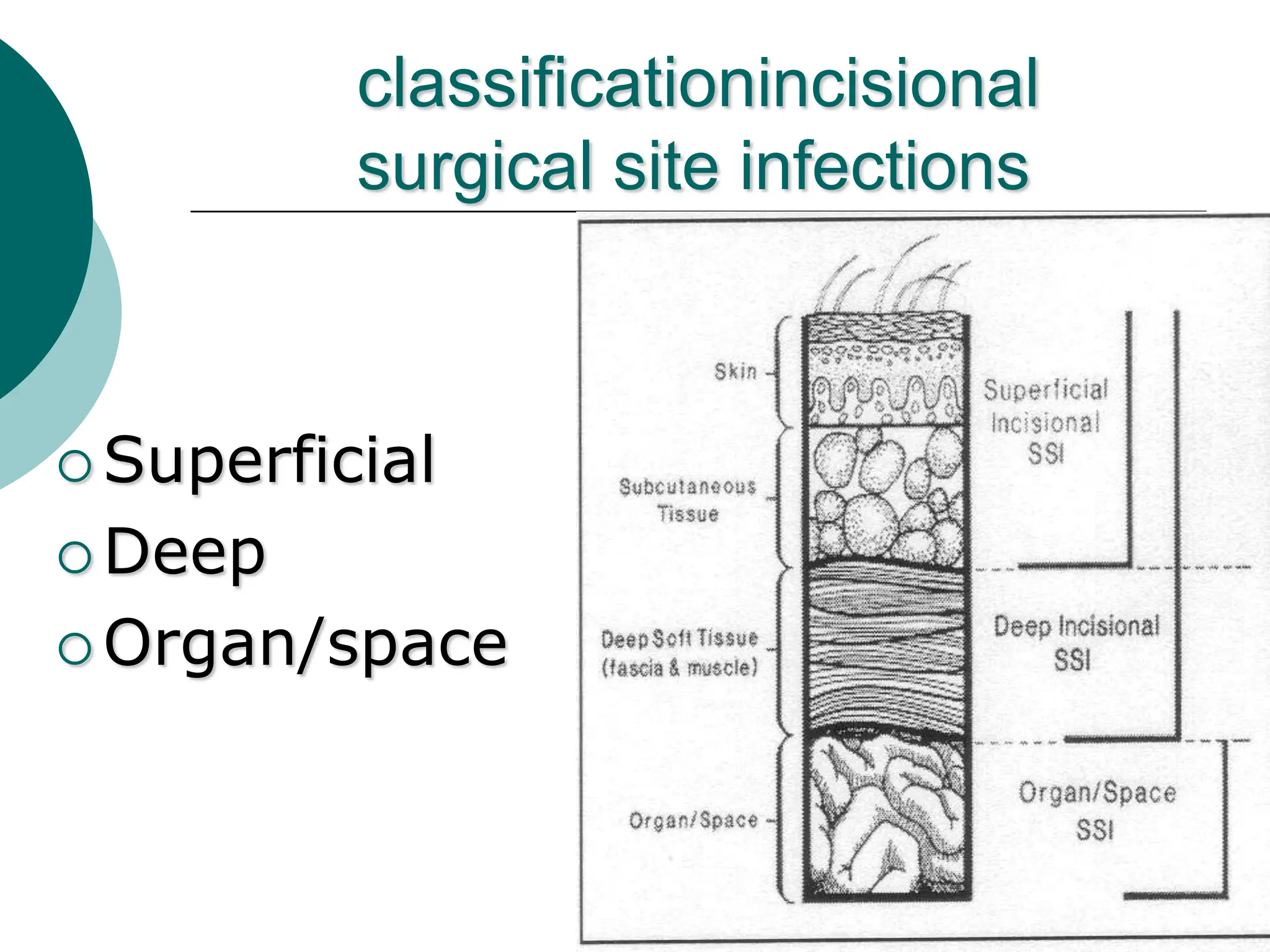 Surgical site Infection and classification.ppt