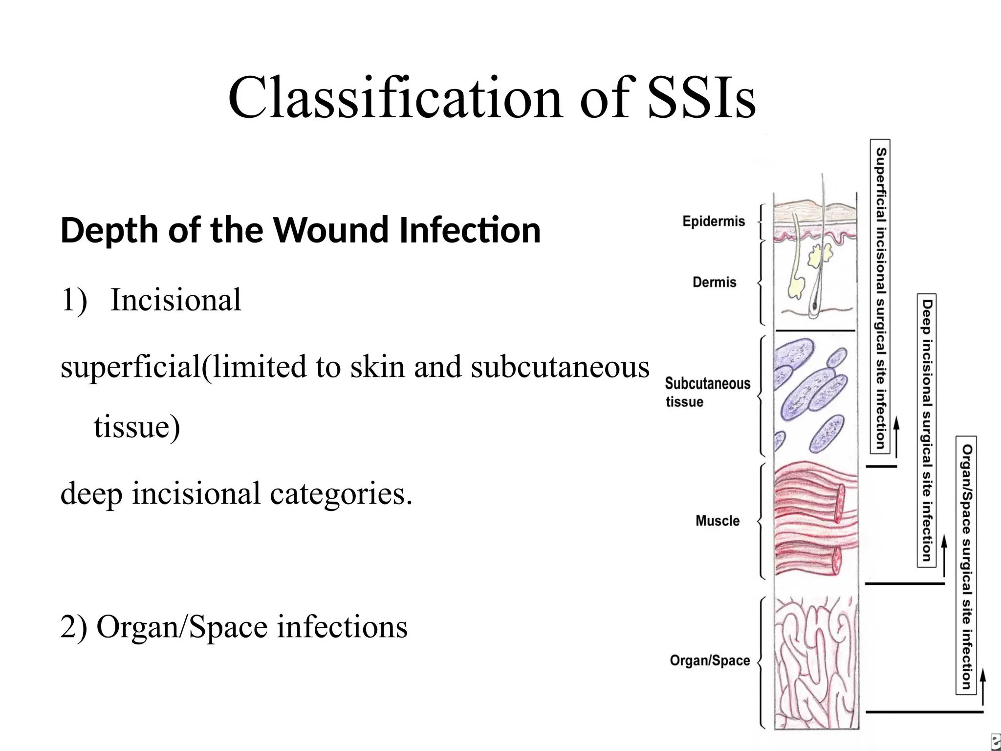 Surgical site infection.pptx : Diagnosis and treatment | PPTX