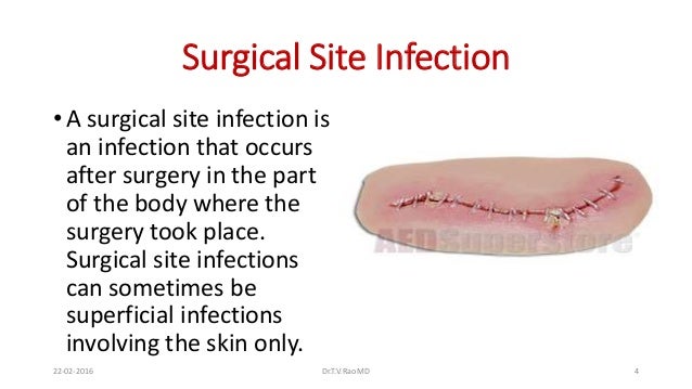 SURGICAL SITE INFECTIONS an update working protocol