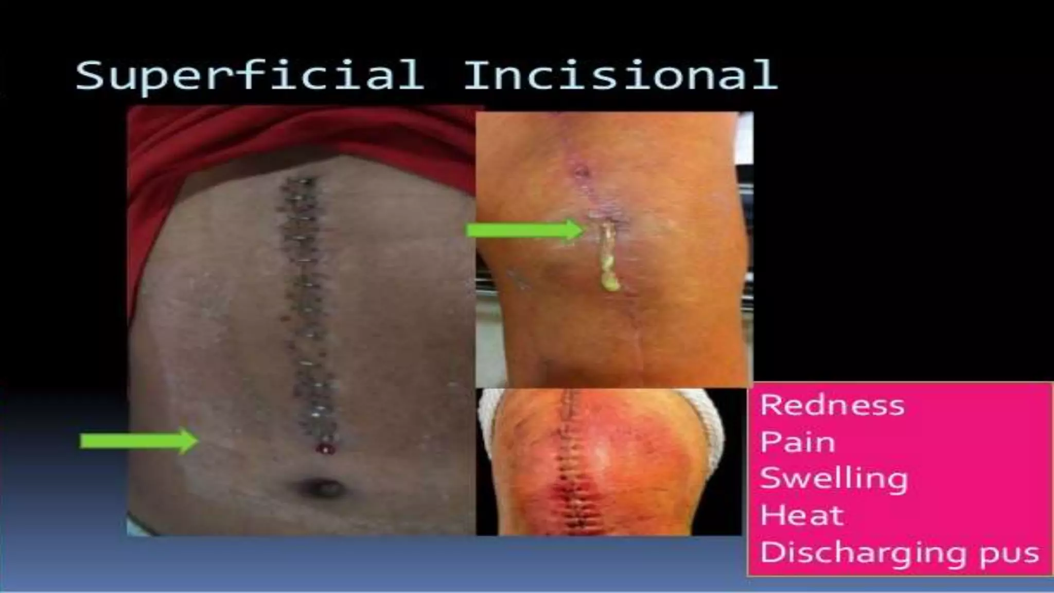 Surgical site infections | PPTX