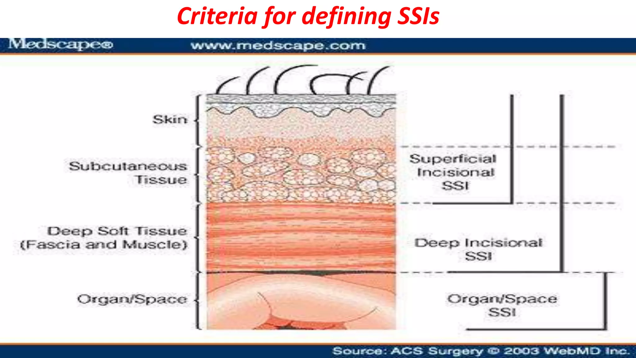 Surgical site infections | PPTX