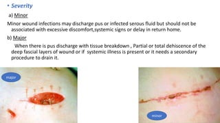 Surgical site infections | PPTX