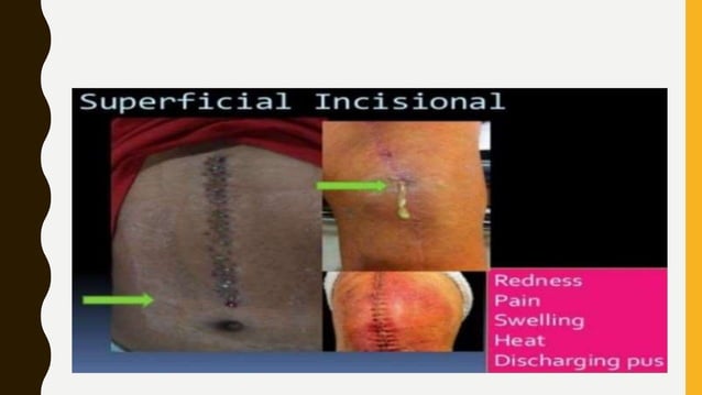 Surgical site infections | PPTX