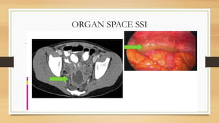 SURGICAL SITE INFECTIONS.pptx
