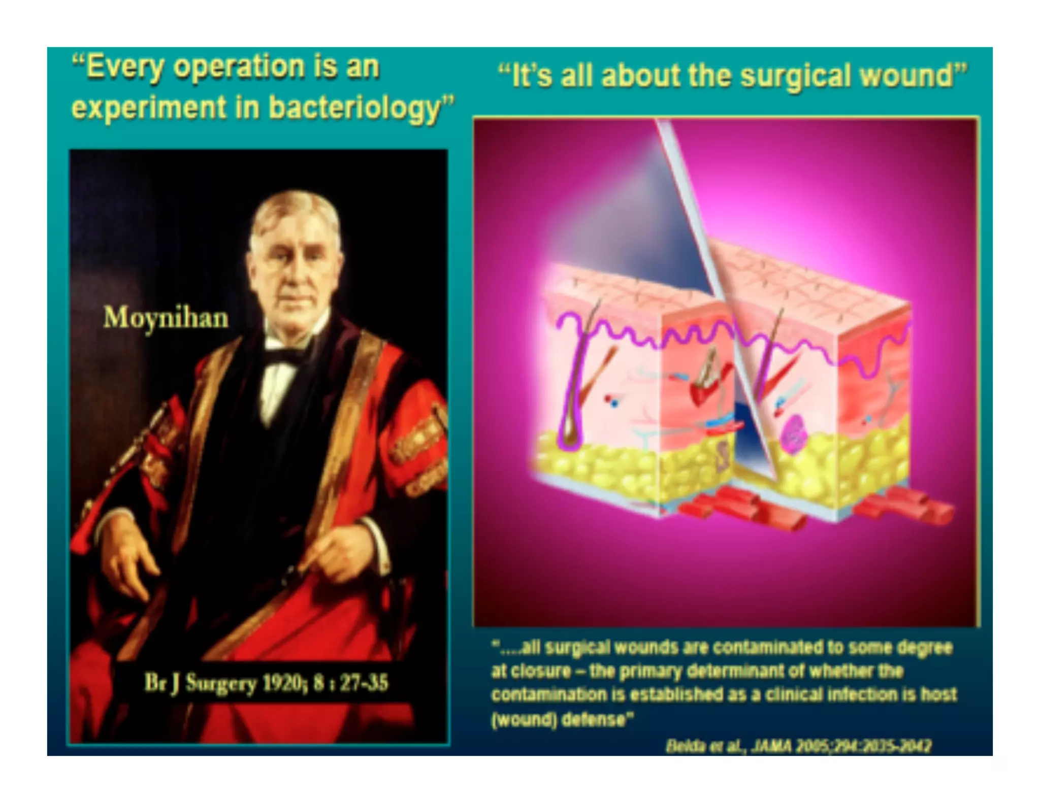 Surgical Site Infection (SSI) | PDF