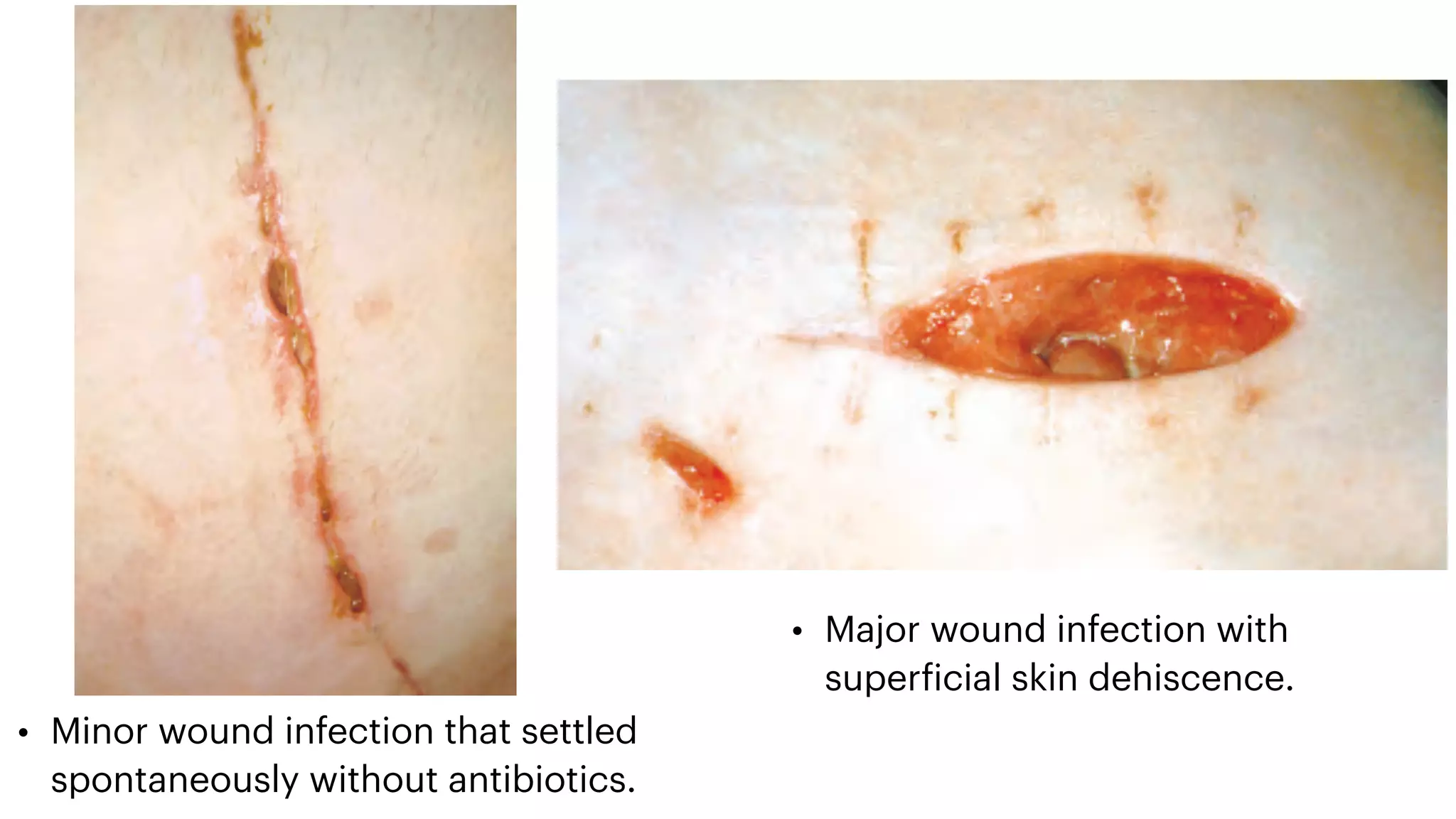 Surgical Site Infection Wound Dehiscence pdf Surgical Site Infection Wound Dehiscence pdf