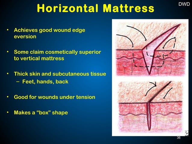 Surgical Sutures and Suturing Techniques | PPT | First Aid | Injuries