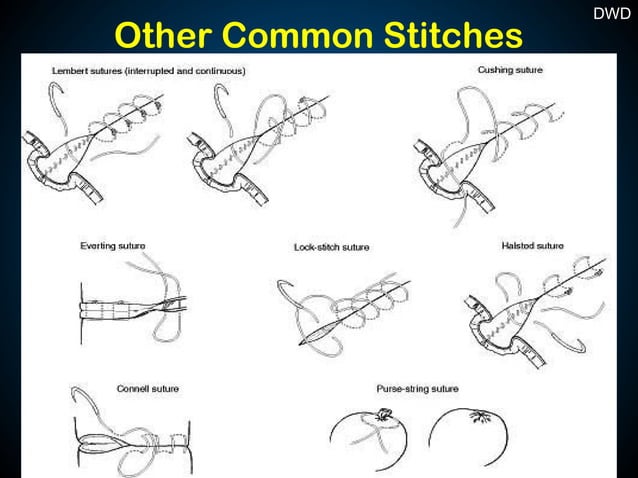 Surgical Sutures and Suturing Techniques