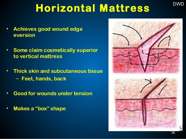 Surgical Sutures and Suturing Techniques