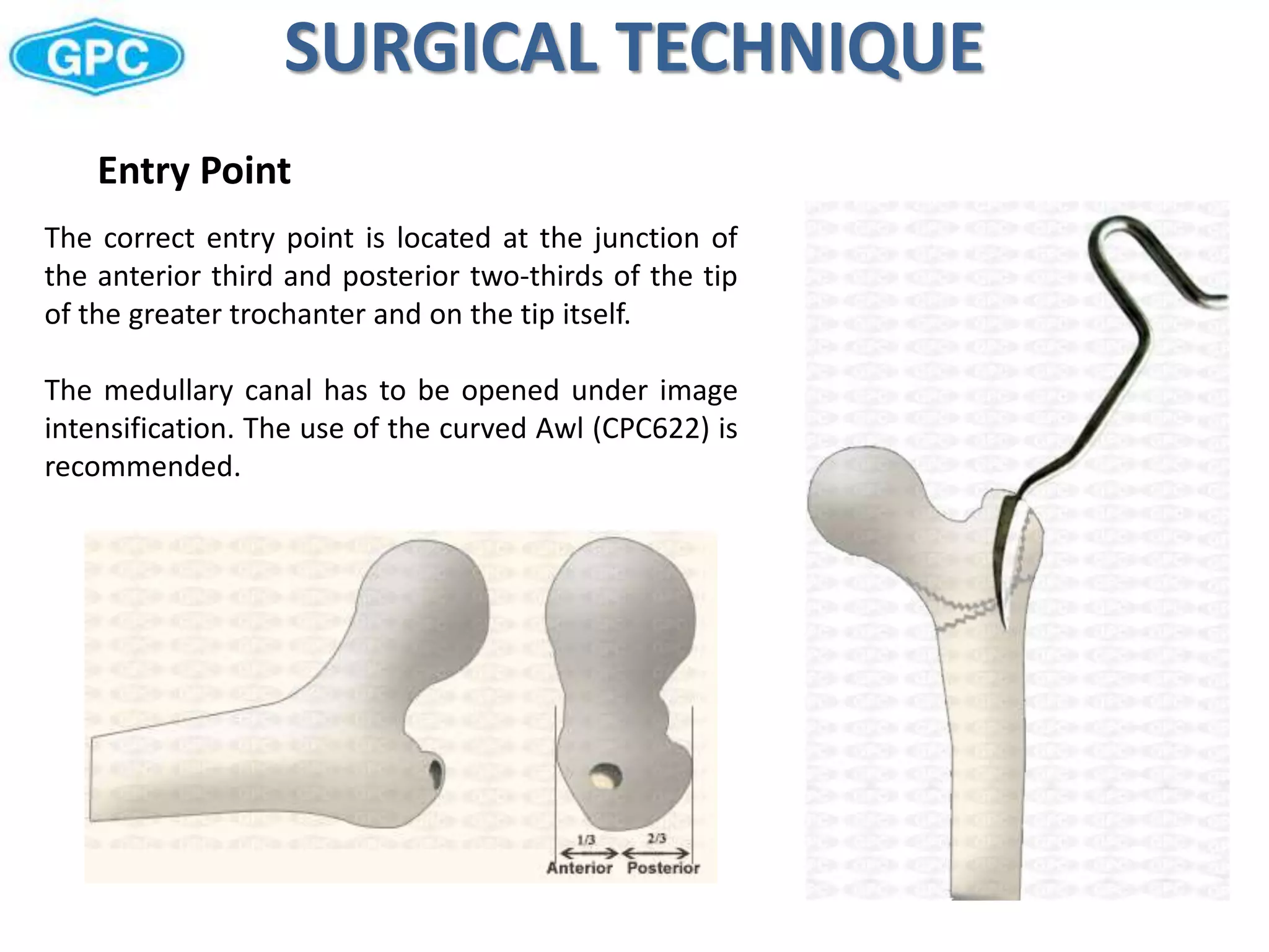 Surgical technique for gama nail | PPTX