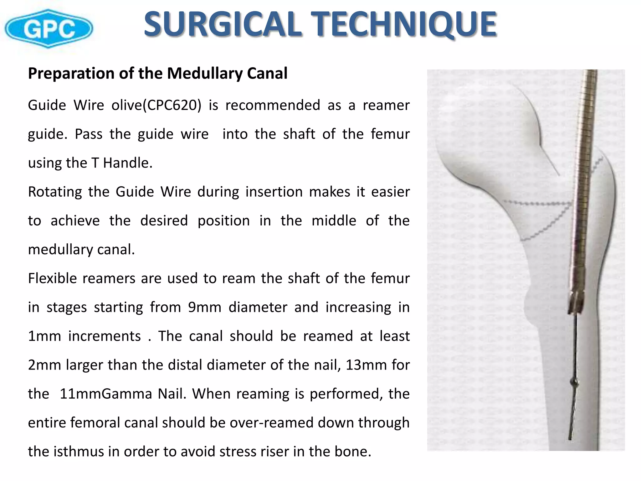 Surgical technique for gama nail | PPTX