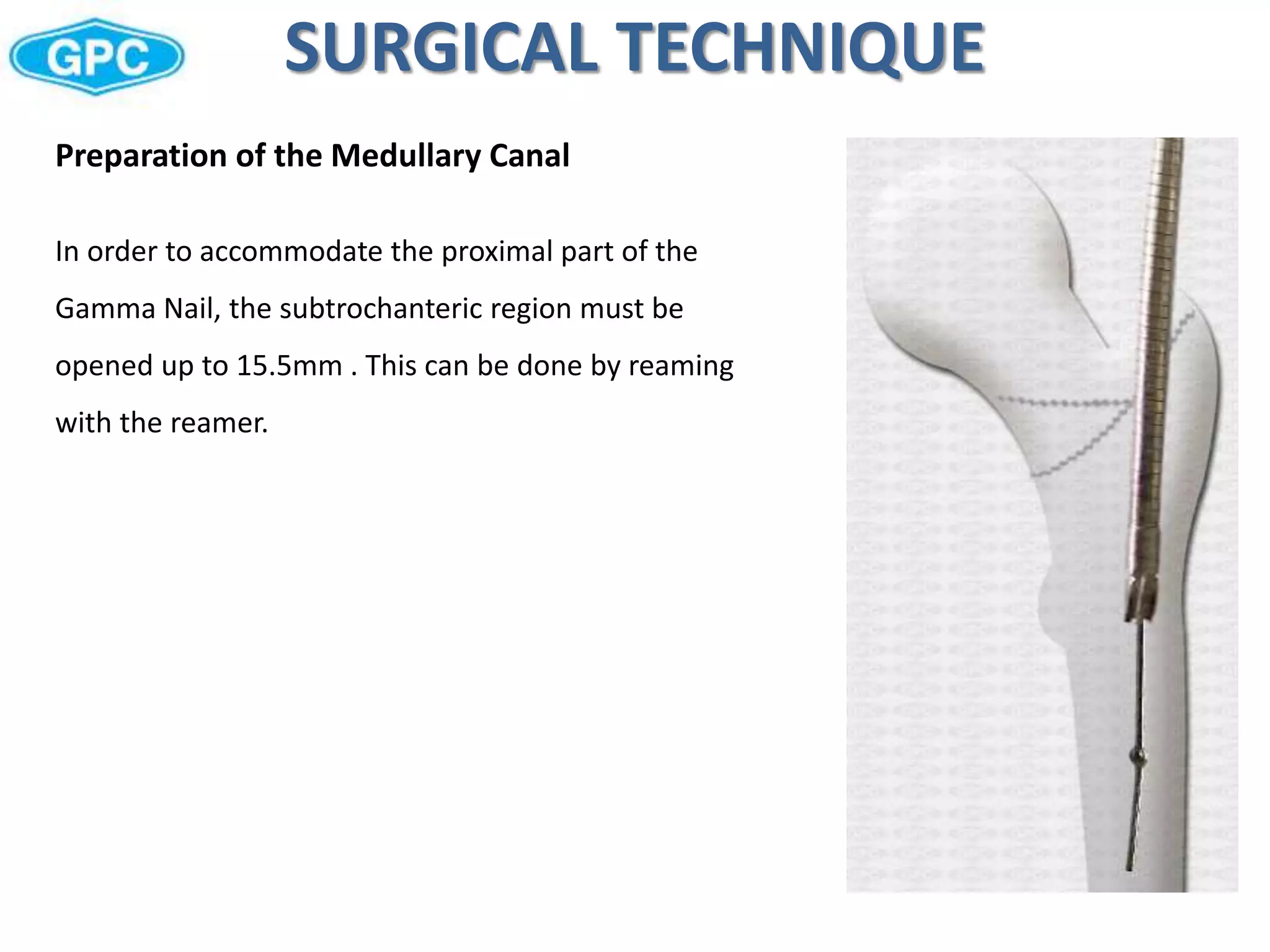 Surgical technique for gama nail | PPTX