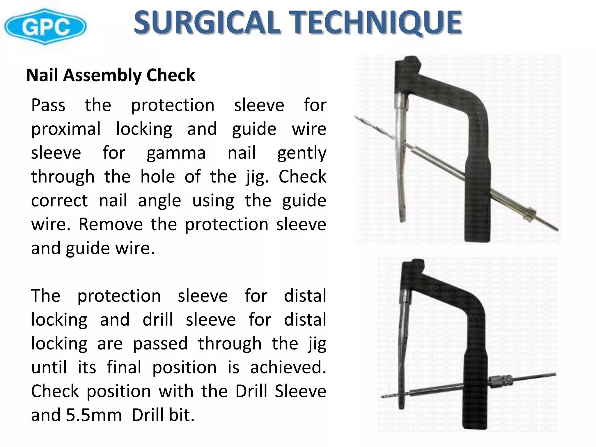Surgical technique for gama nail | PPTX