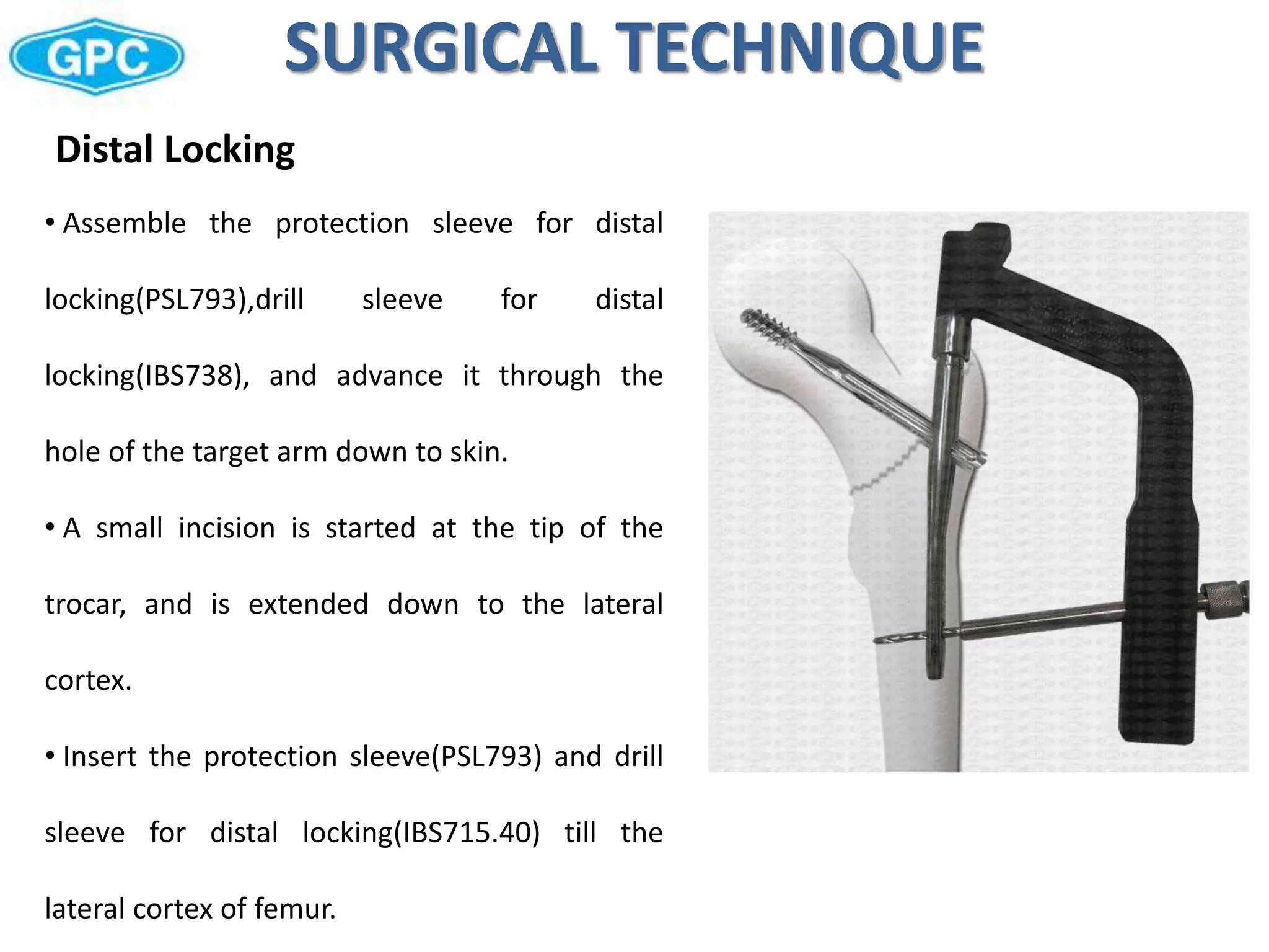 Surgical technique for gama nail | PPTX